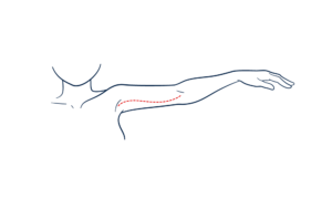 Arm Lift (Brachioplasty) · Dr. Schneider · Fort Myers, Naples, Cape Coral